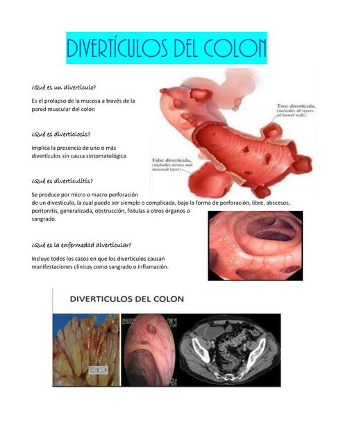 Divertículos del Colon | mariana echavez | uDocz