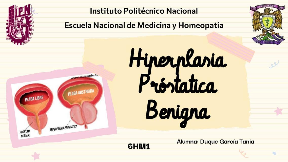 Hiperplasia Prostática Benigna | Tania Duque García | uDocz