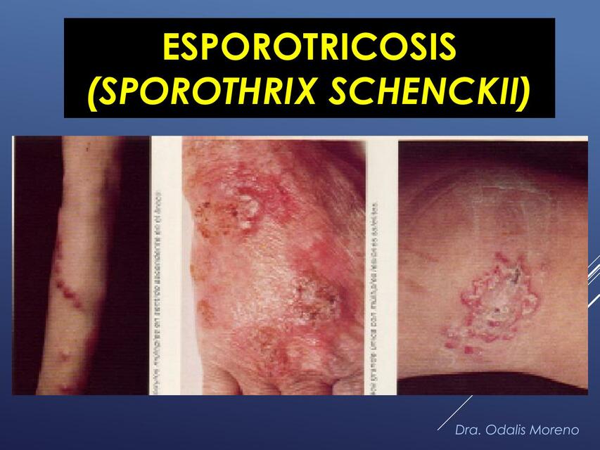 🦶 Esporotricosis Sporothrix schenckii - 🍄MICOLOGÍA🍄 | Dra Odalis Moreno ...