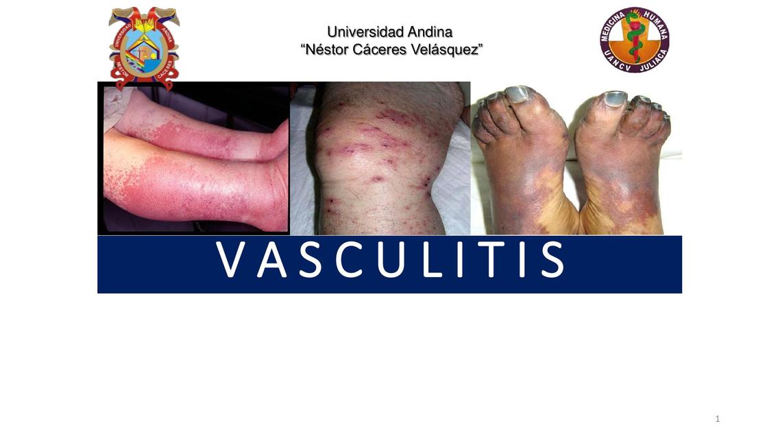 Vasculitis | Sara Sanca Turpo | uDocz