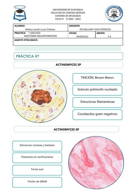 Micetoma Hialohifomicosis | Janeth Lucas | uDocz