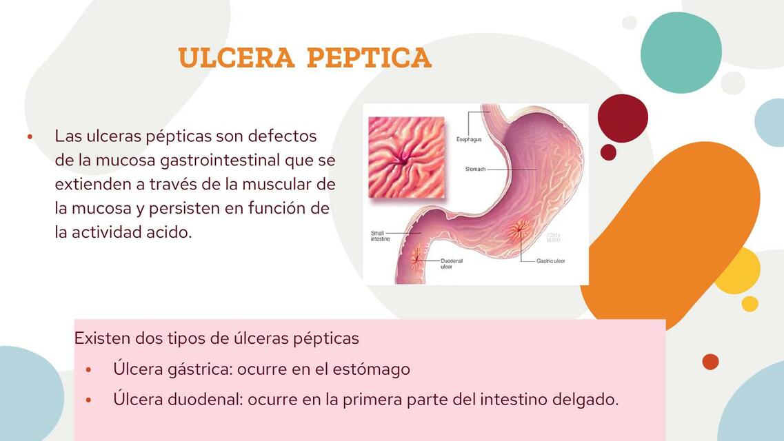 Úlceras Pépticas | uDocz