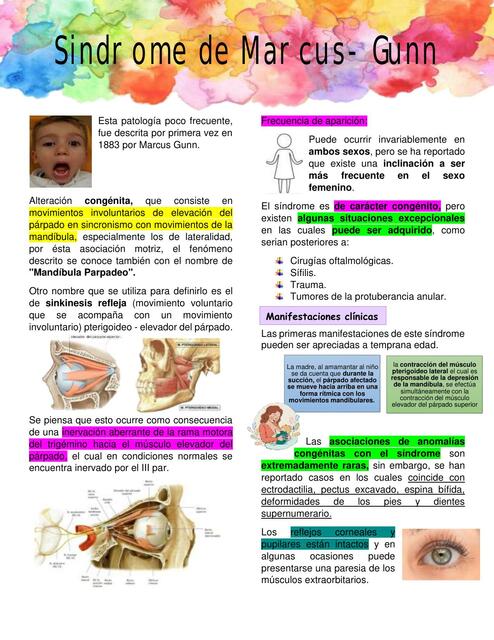 Sindrome de Marcus Gunn | Karen Jimenez | uDocz