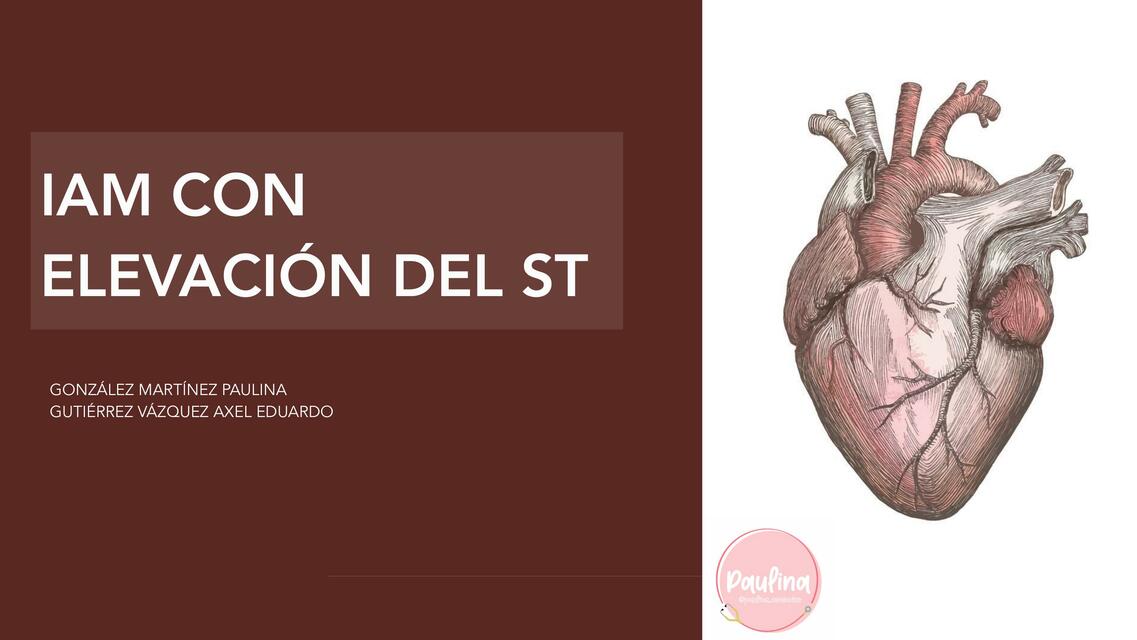 Infarto Agudo de Miocardio con elevación del segmento ST (IAMCEST ...