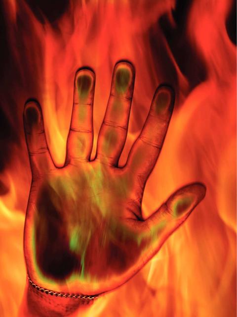 Cuidados de enfermería en pacientes quemados | Ludmila Gómez | uDocz