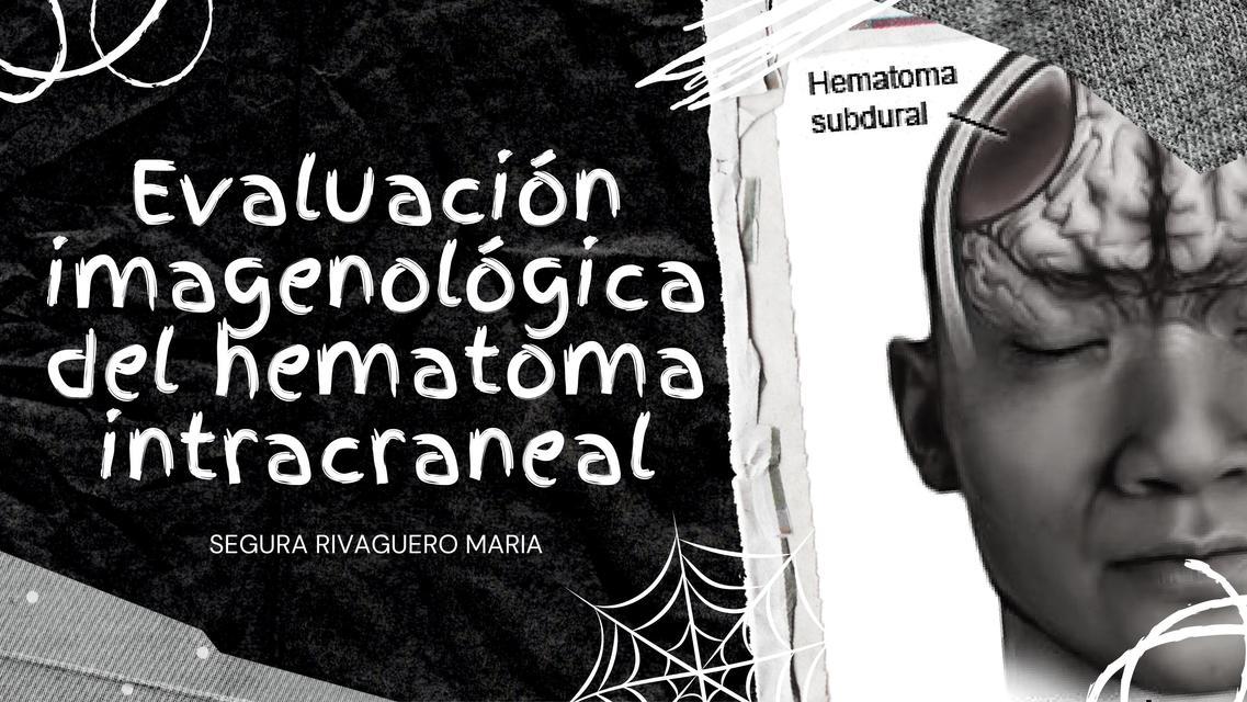 Hematoma Intracraneal | MARIA SEGURA | uDocz