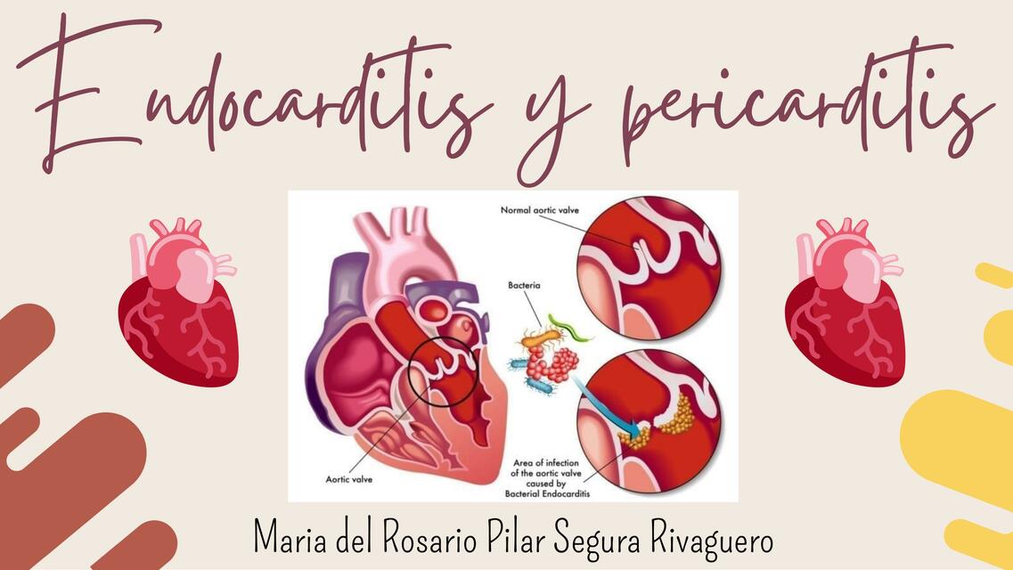 Endocarditis y Pericarditis | MARIA SEGURA | uDocz