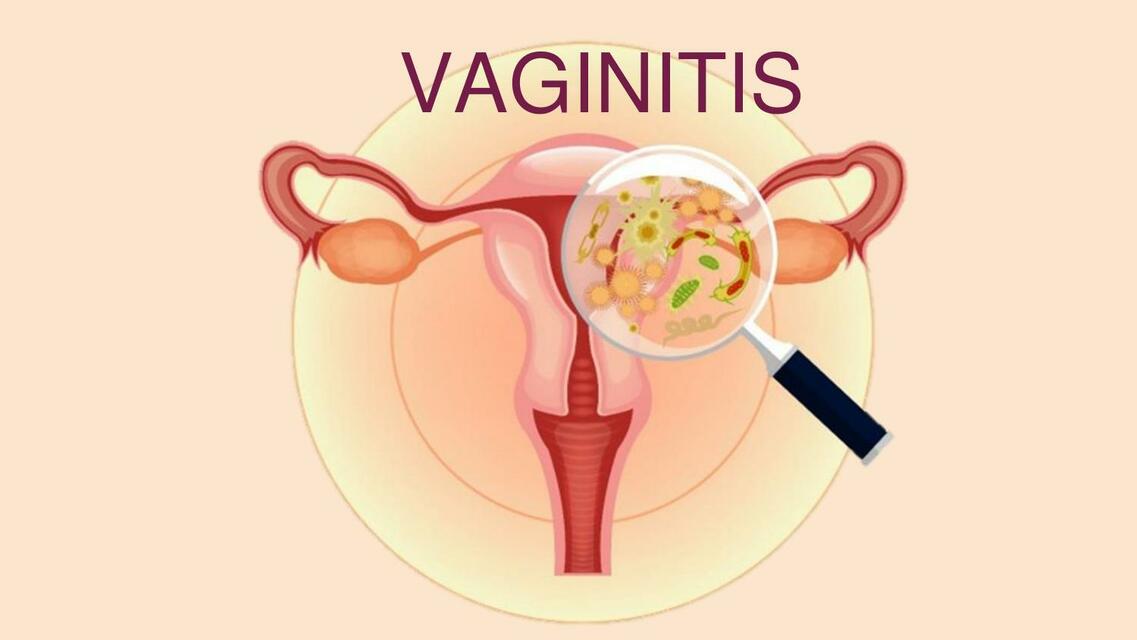 Vaginitis y EPI | Delia Caballero Mas | uDocz