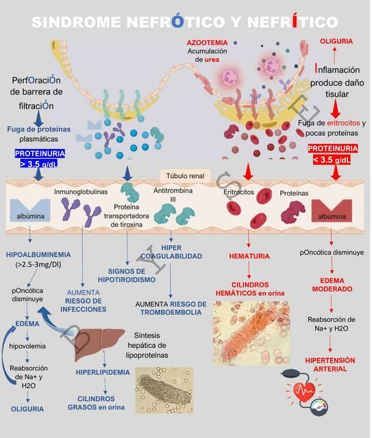 Síndrome Nefrótico y Nefrítico | Briggitte Yamilé Suarez Esteban | uDocz