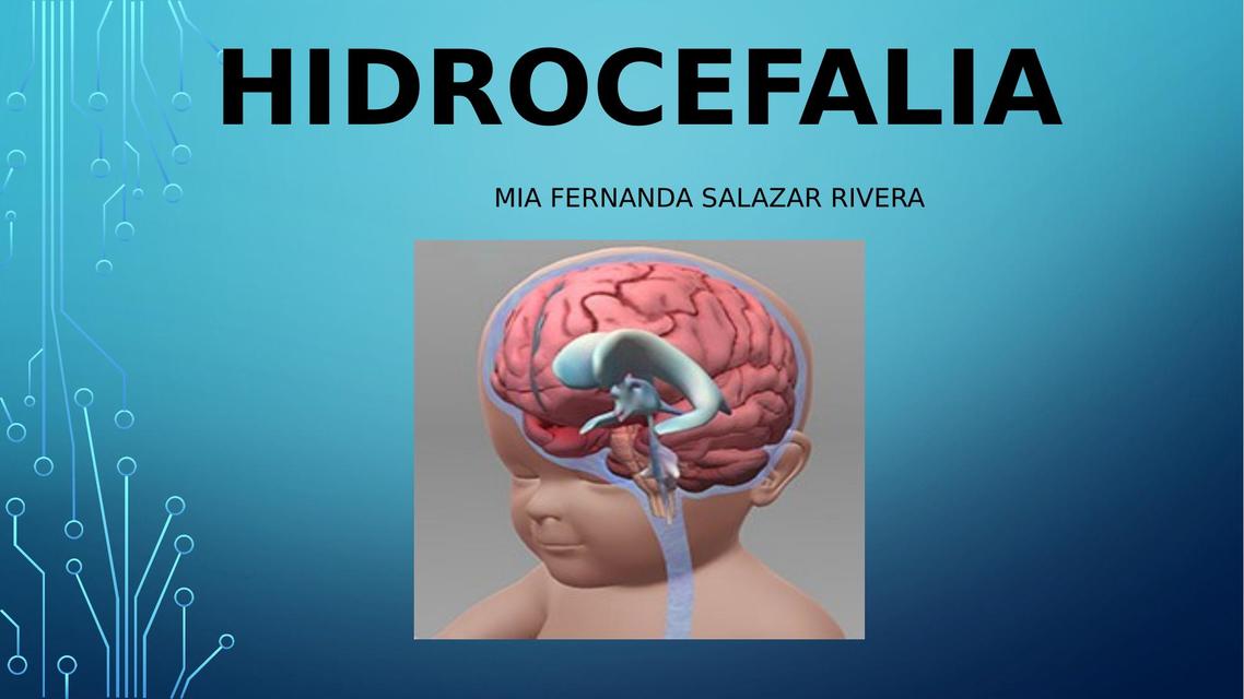 Hidrocefalia | MFSR | uDocz