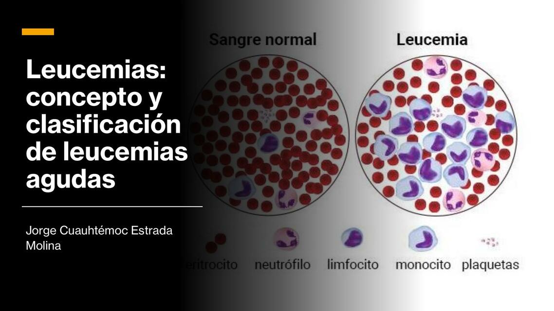 Resúmenes de Clasificación de leucemia | Descarga apuntes de ...