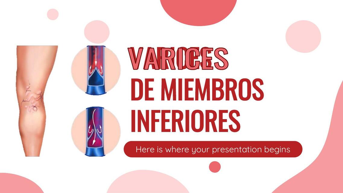 Varices de Miembros Inferiores | Elizabeth | uDocz