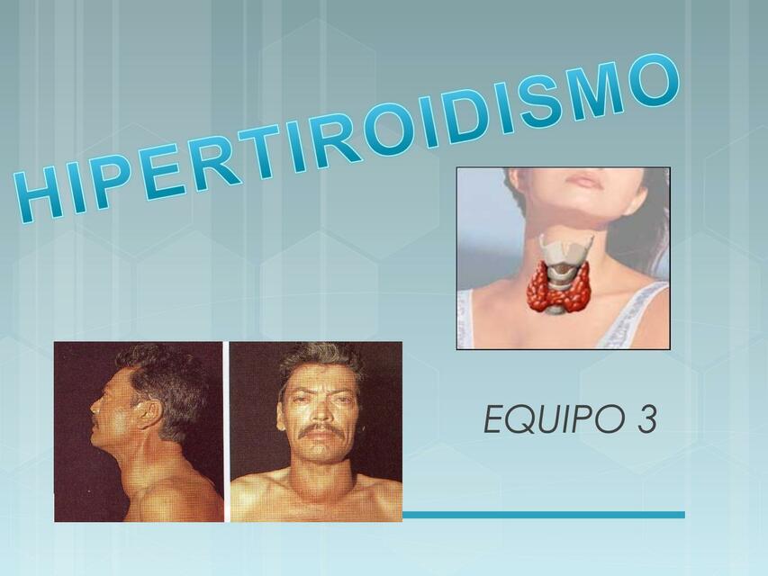 Hipertiroidismo | José luis Mirones andrade | uDocz