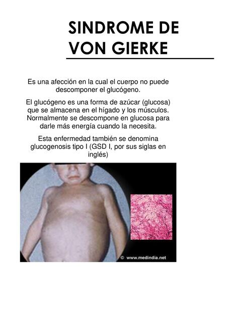 Síndrome De Von Gierke Manuel Alvarado Udocz