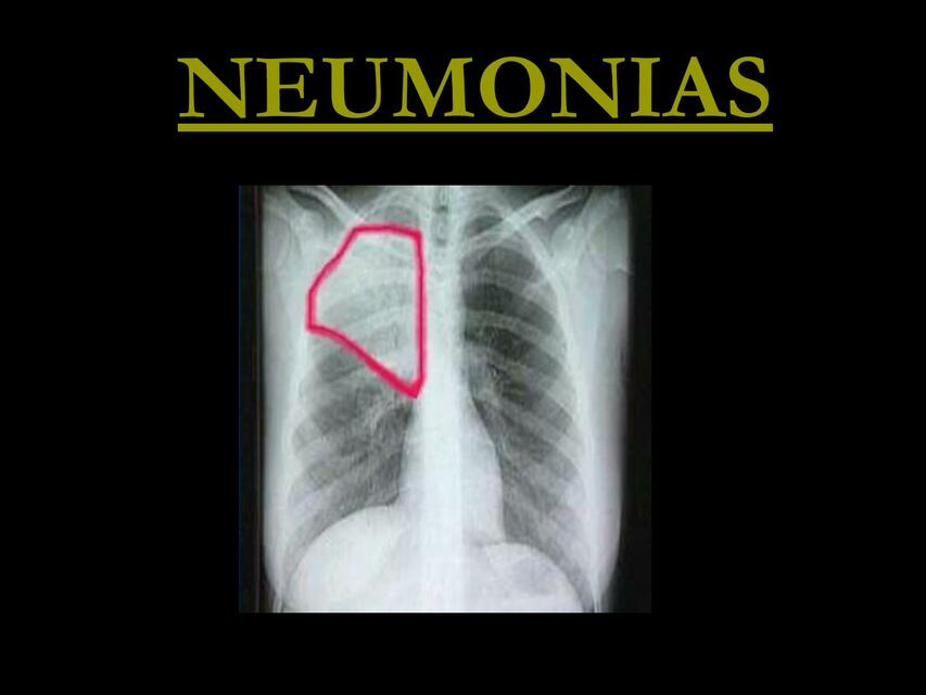 Neumonía Clase 1 | Itzel Lopez | uDocz