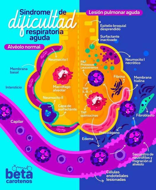 Síndrome De Distrés Respiratorio | MedicineDat | uDocz