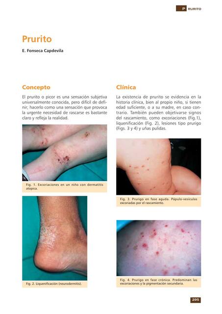 Prurito | Elias Calei | uDocz