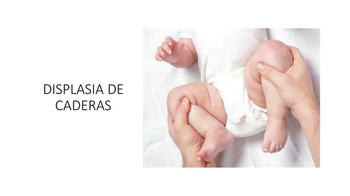 Displasia De Caderas | Mary Mednotes | uDocz