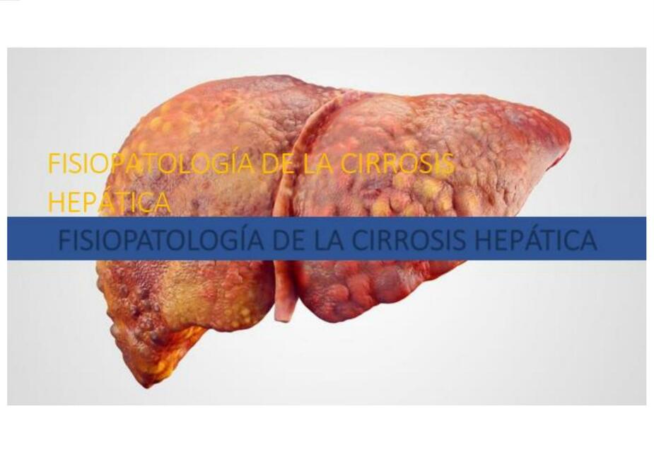 12 Fisiopatología de la Cirrosis Hepática | LiquidOH愛 | uDocz