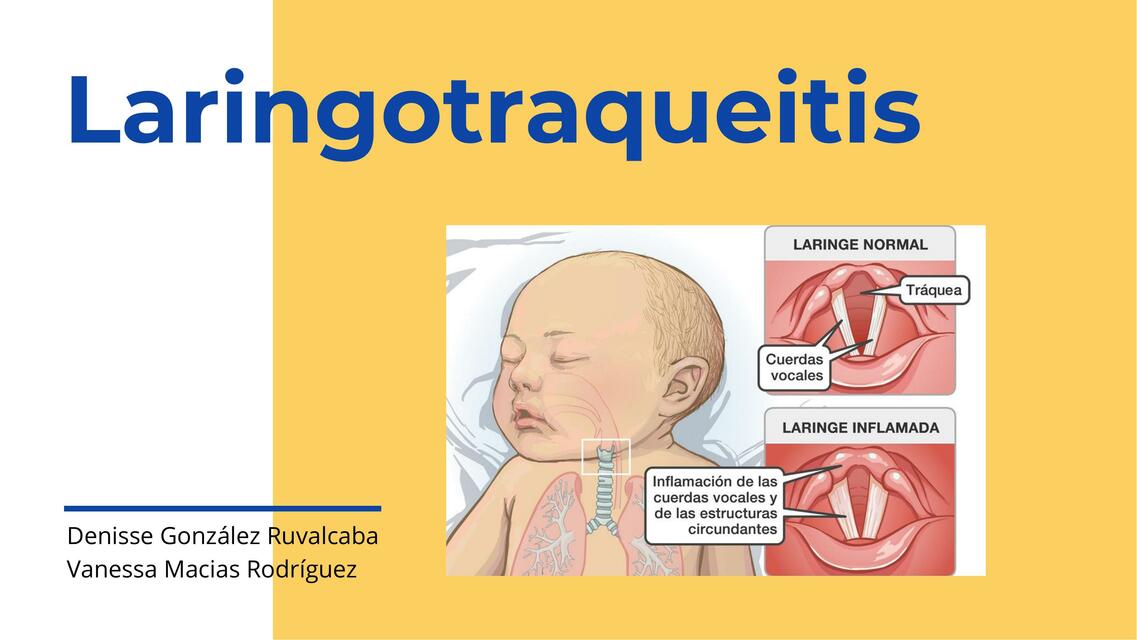 Laringotraqueitis | VICTORIA ISABEL ELIZONDO SUAREZ | uDocz
