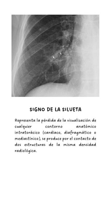 Signos Radiológicos de Tórax | Jessie Canton | uDocz