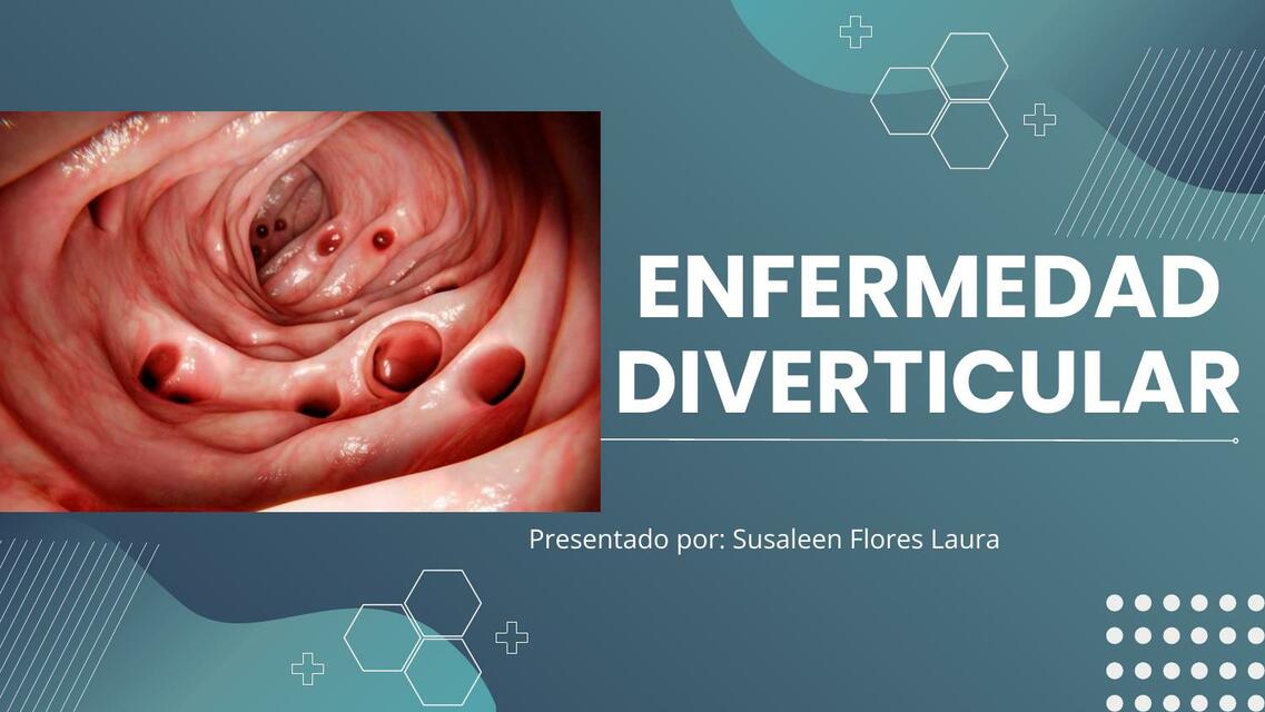 Enfermedad Diverticular | Susaleen Flores Laura | uDocz