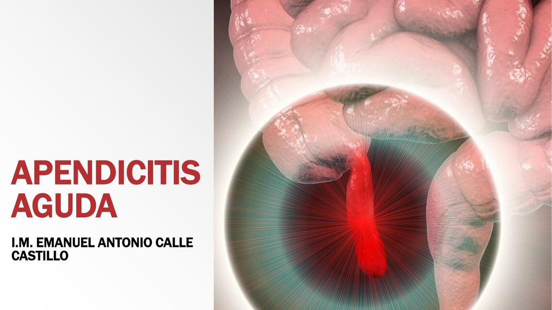 Apendicitis Aguda | Emanuel Calle | uDocz