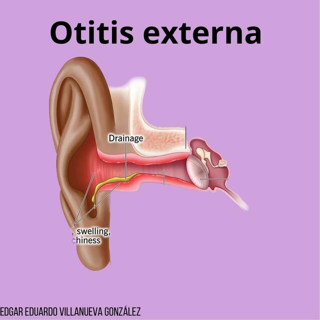 Otitis Externa | Dr.Villanueva | uDocz