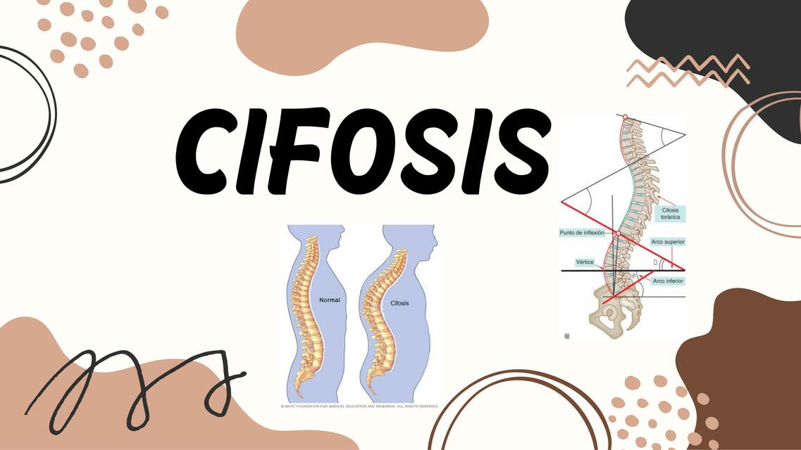 Cifosis | Breenstudy | uDocz
