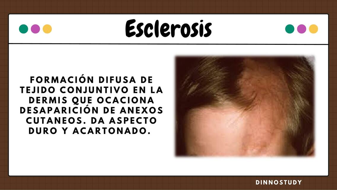 Esclerosis: Formación difusa de tejido conjuntivo en la dermis que ...