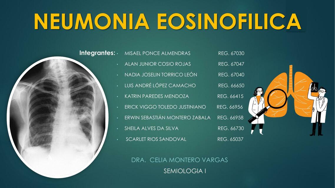 Neumonía Eosinofílica | Misael Ponce | uDocz