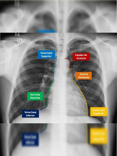 Bordes De Silueta Cardiovascular Rx De Tórax | Enfermero Isaias Rivas ...