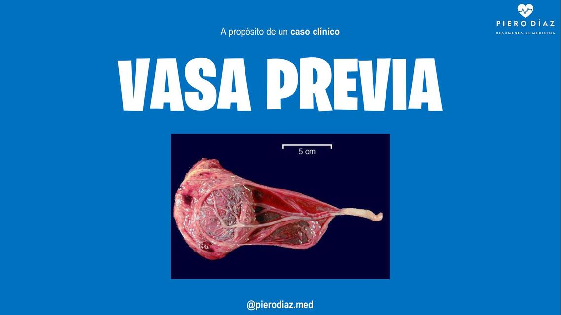 VASA PREVIA - pierodiaz med | pierodiaz.med | uDocz