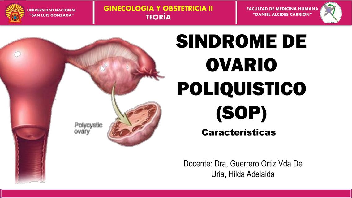 Síndrome de ovario poliquístico | ximena cabezudo | uDocz