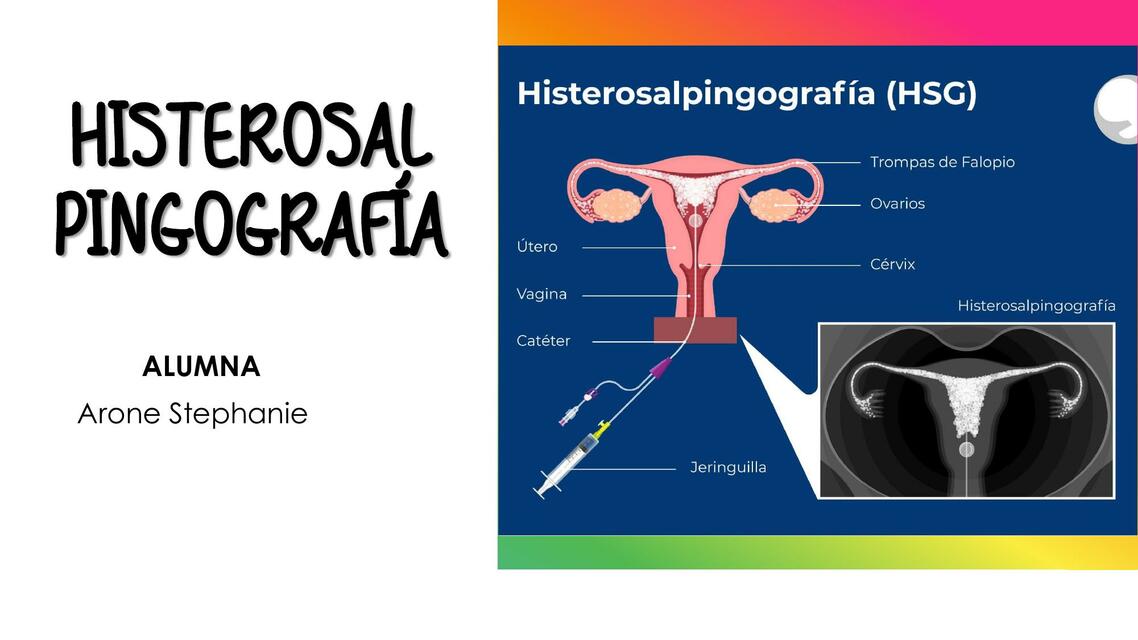 Histerosalpingografía | Stephanie Arone | uDocz