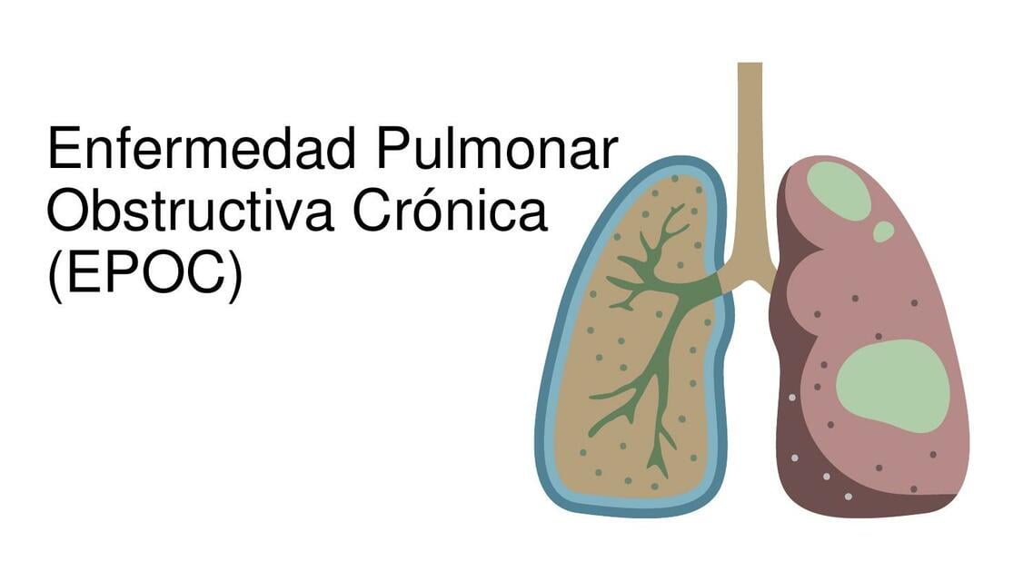 Enfermedad Pulmonar Obstructiva Crónica (EPOC) | Arturo Canelon ...