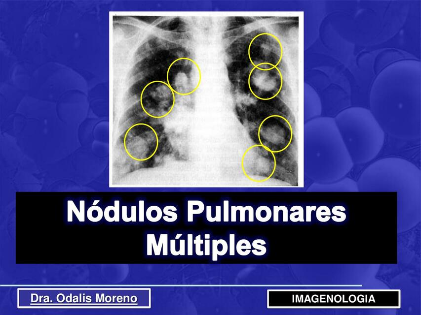 📸NODULO PULMONAR MULTIPLES🫁 - IMAGENOLOGÍA 🩻 | Dra Odalis Moreno | uDocz