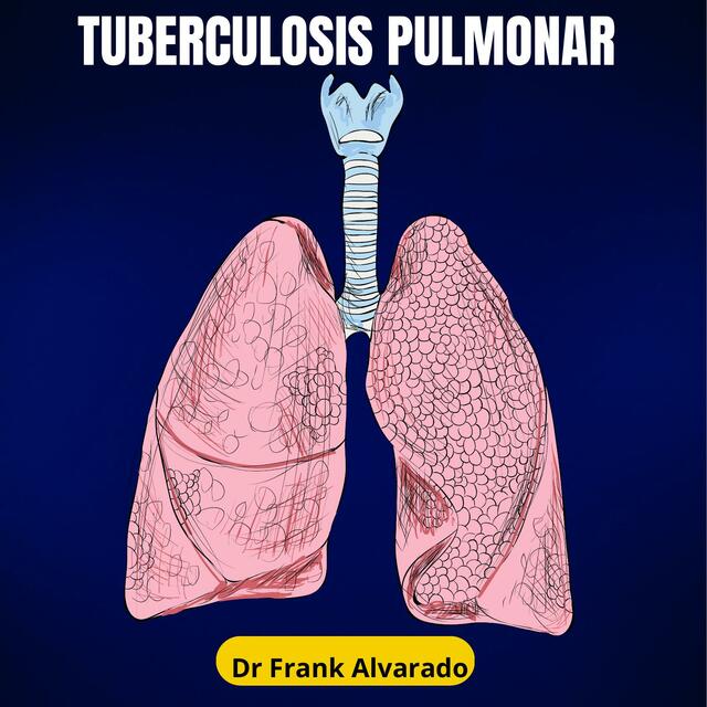 Tuberculosis pulmonar | Moisés Francisco Alvarado García | uDocz