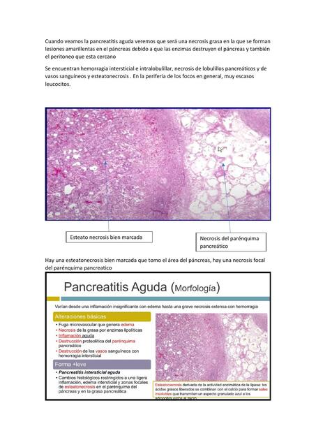 pancreatitis | Alexander Valencia | uDocz