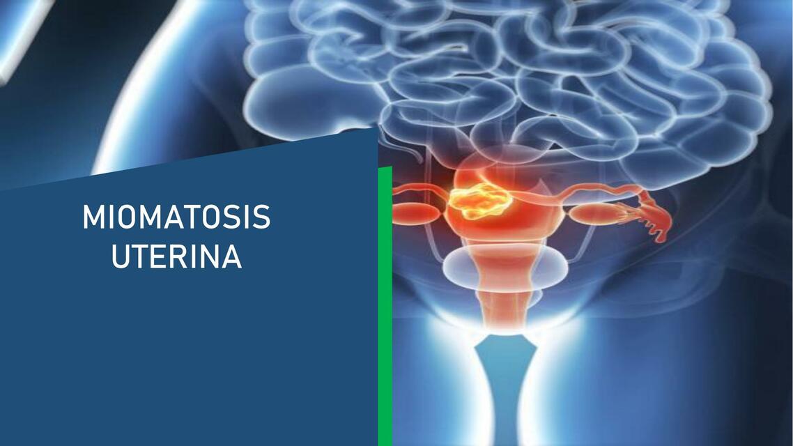 Miomatosis Uterina | Amelia McBones | uDocz