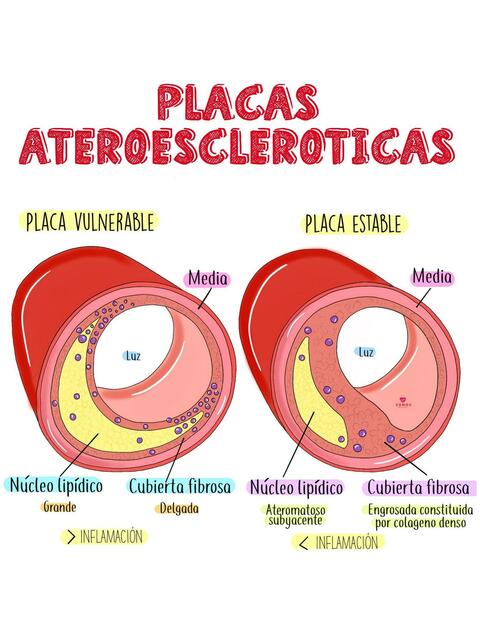 Placas Ateroescleróticas | Enfermero Isaias Rivas | uDocz