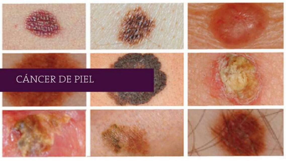 Cancer de piel | Julissa karolina Castillo llontop | uDocz