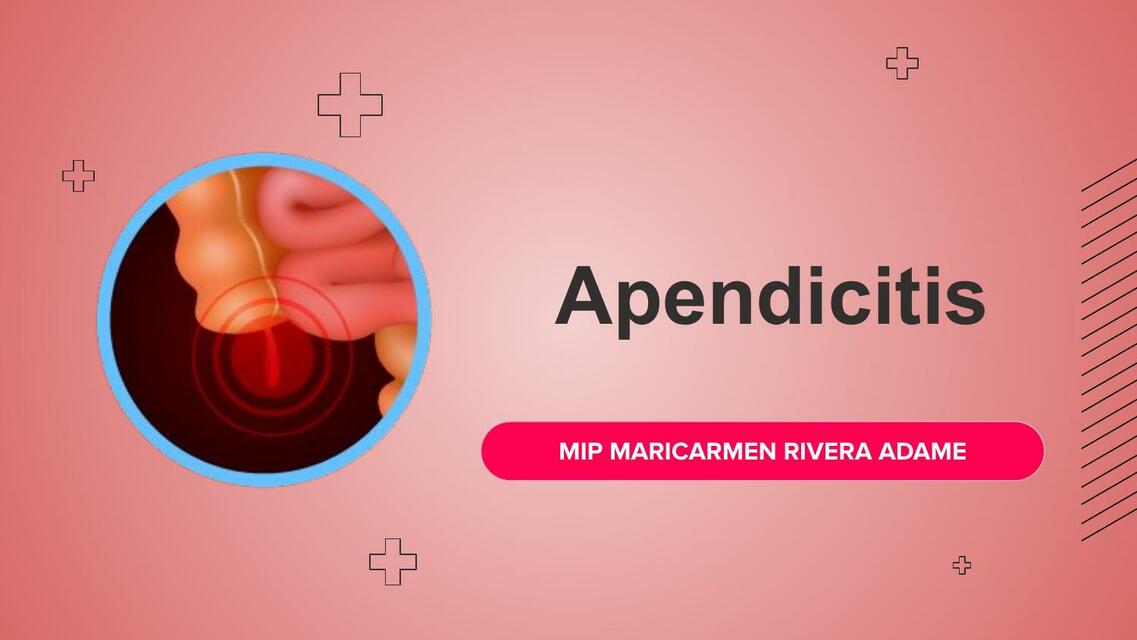 Apendicitis abdomen agudo | Maricarmen Adame | uDocz