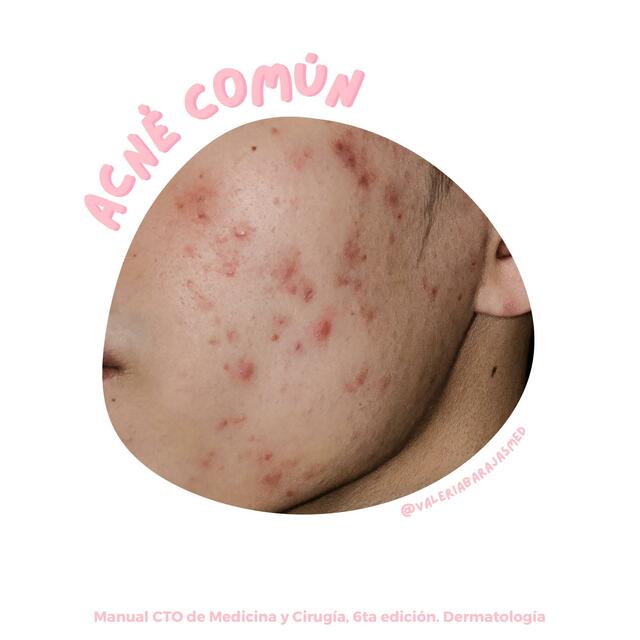 Acné común - dermatología | Valeria Michell Barajas | uDocz