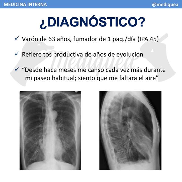 Enfisema | Ariel | uDocz