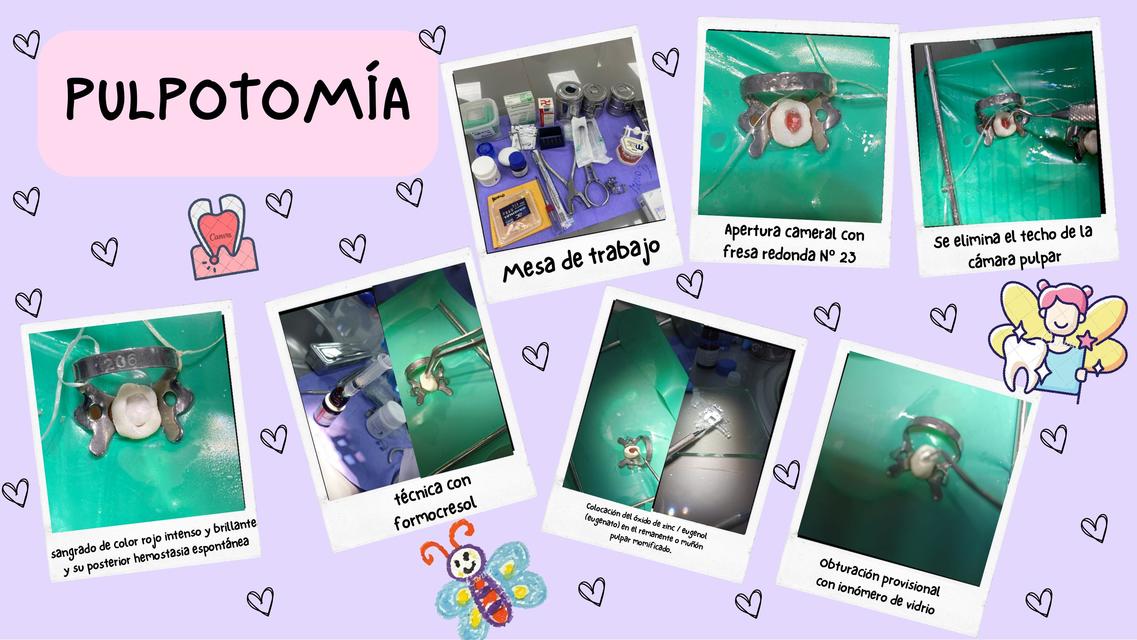 Pulpotomía | odontología | uDocz