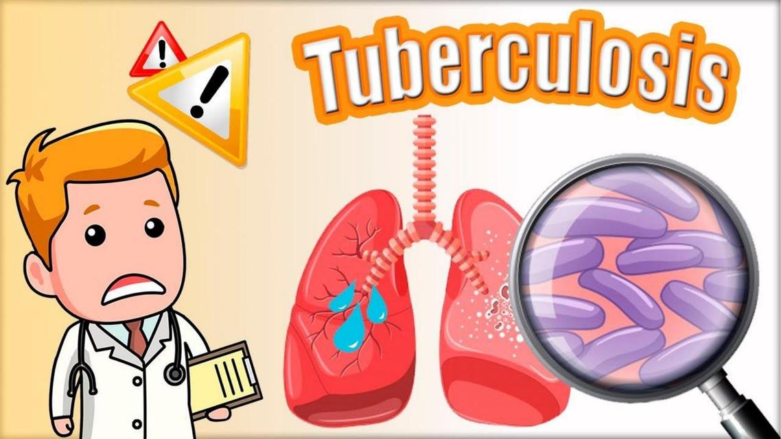Tuberculosis | ENFERMERIA | uDocz