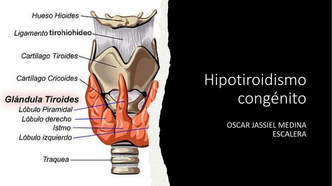 Hipotiroidismo congénito | uDocz