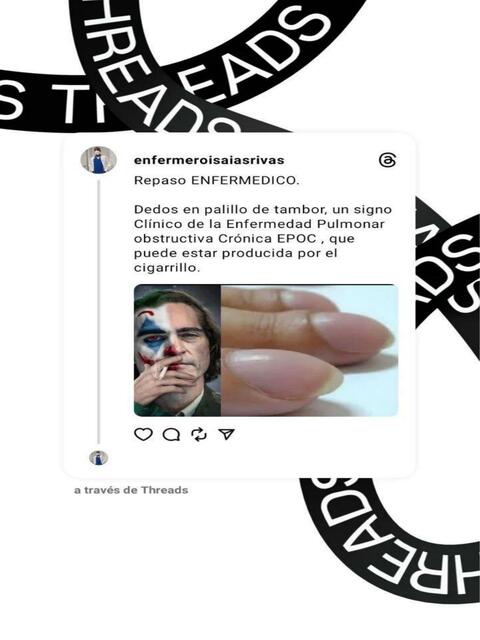 Dedos de Palillos de Tambor | Enfermero Isaias Rivas | uDocz