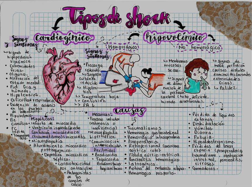 Tipos de Shock | Nelly_notes.med | uDocz